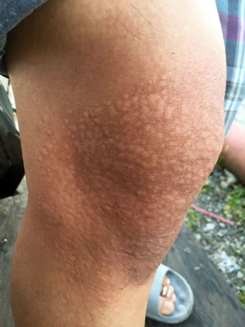 Daun Gatal; Obat Tradisional Papua | Berbagi Tak Pernah Rugi